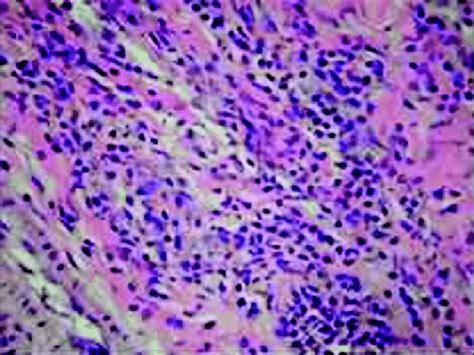 Hyperproliferation In Epidermal Layer With Abundance Inflammatory Cells Download Scientific