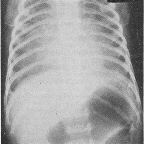 X Ray At Age 3 Months Note Clouded Lung Fields Absent Thymic Shadow