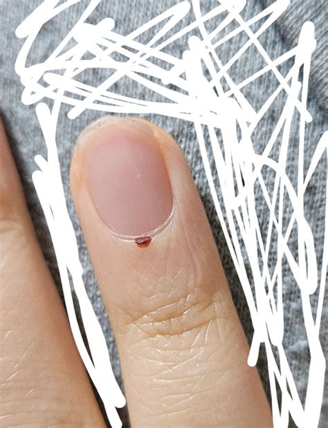 손톱쪽에 빨간색 반점이 생겼어요 지식in