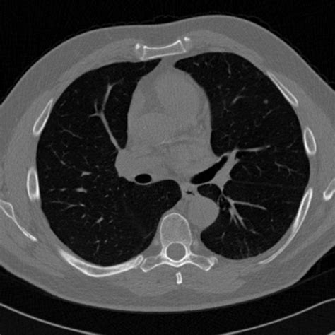 Lungcancerdetection Object Detection Dataset By Tcc
