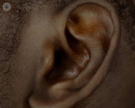 Eardrum Perforation A Comprehensive Guide Top Doctors