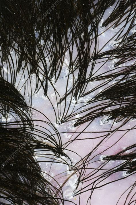 Lichen Planopilaris Dermoscopy Stock Image C0601299 Science