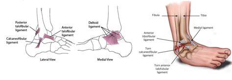Deltoid Ligament Ankle Sprain