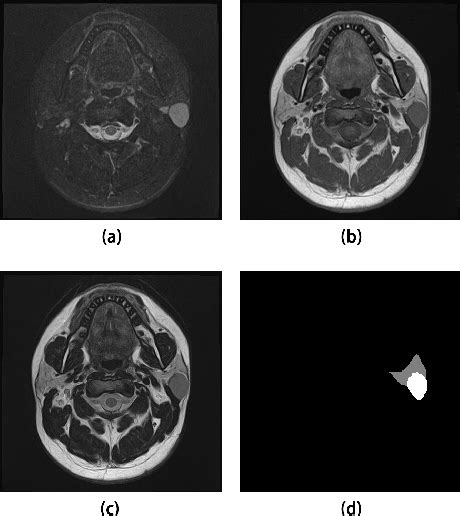 Parotid Gland Mri Segmentation Based On Swin Unet And Multimodal Images
