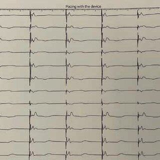 Recording Of The Paced QRS Morphology Of The Left Bundle Branch Download Scientific Diagram