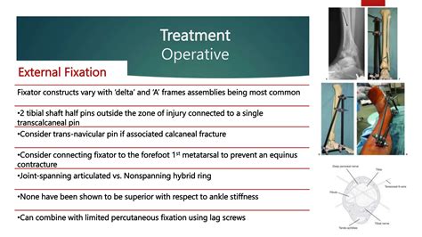 Diagnosis And Management Of Tibial Plafond Pilon Fracture Pptx