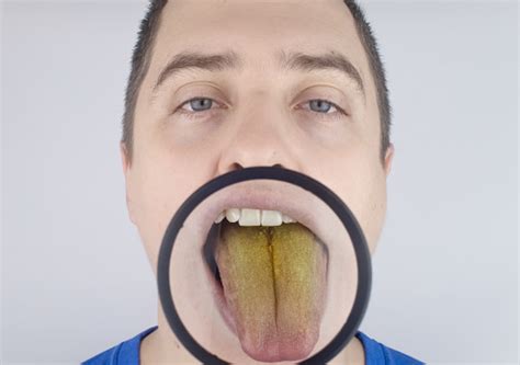 El Hombre Tiene Una Lengua Amarilla Recubrimiento Amarillo Doloroso En