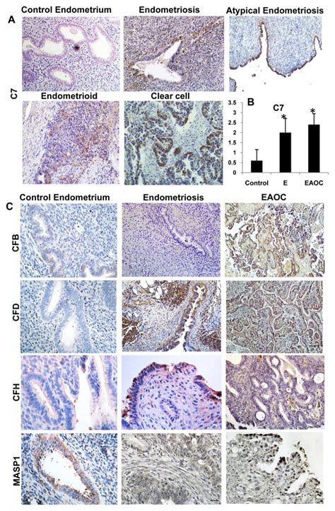 Complement Pathway Is Frequently Altered In Endometriosis And