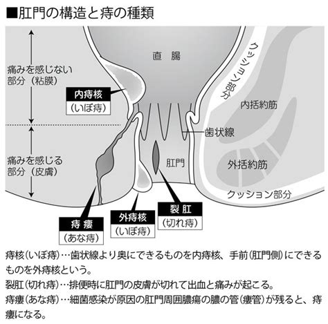写真・図版（3枚目） 手術で便失禁のリスクも！ 失敗できない痔の治療、病院の選び方 Aera Dot アエラドット