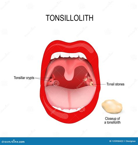 Tonsil Stones Vector Illustration Labeled Medical Tonsillolith