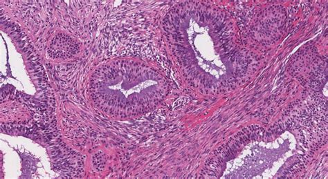 Biphenotypic Sinonasal Sarcoma Ottawa Atlas Of Pathology
