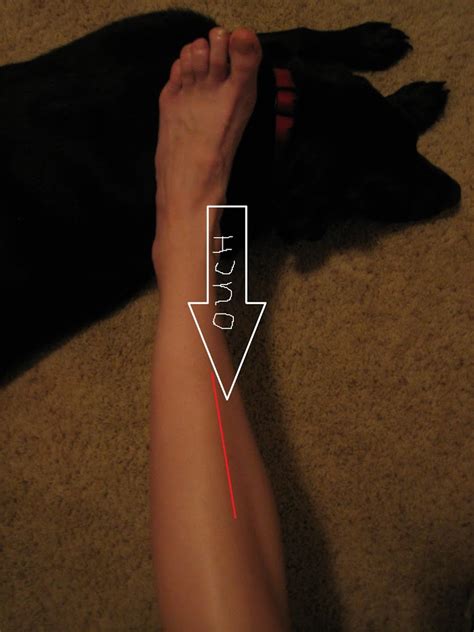 How To Cure Shin Splints Maybe Running And Then Blogging About It