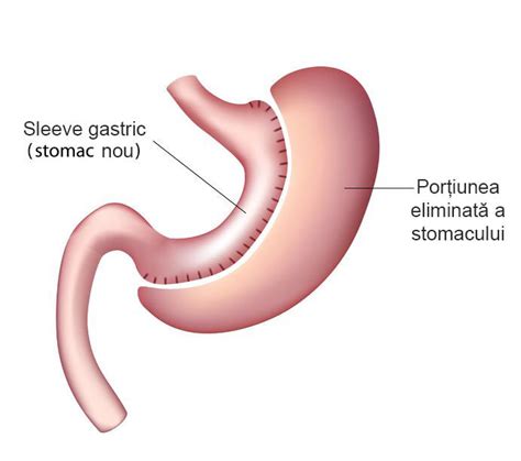 Reducing Stomach Volume By The Use Of A Gastric Sleeve Laparoscopic Longitudinal Gastrectomy