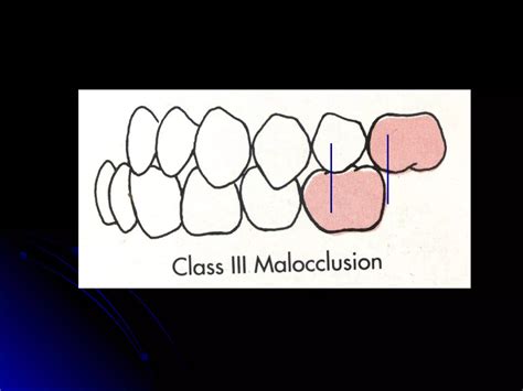 Classification Of Normal Occlusion And Malocclusion Ppt