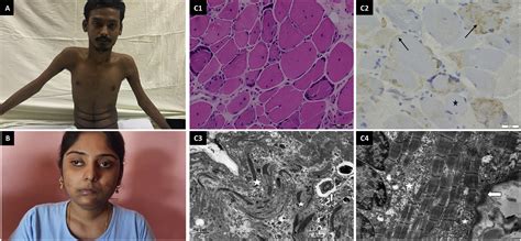 Partial Loss Of Desmin Expression Due To A Leaky Splice Site Variant In