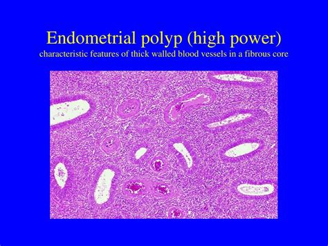 Ppt Endometrial Polyps Powerpoint Presentation Free Download Id 1273789