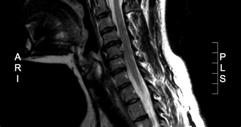 MRI To Diagnose A Herniated Disc Discseel