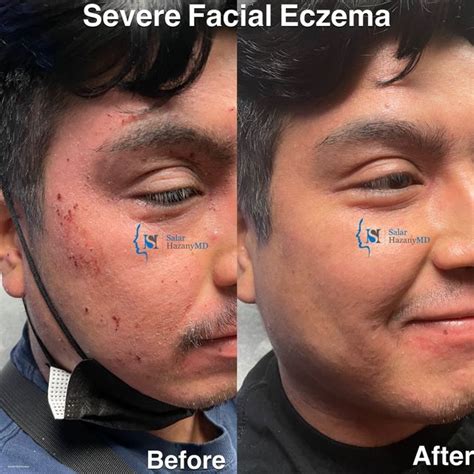 Atopic Dermatitis On Face Treatment