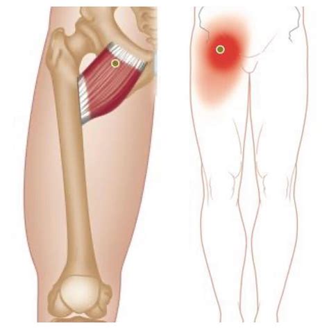 💡pectineus Trigger Points Ross Chiropractic And Wellness