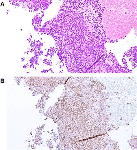 Mediastinal Lymph Node Resected During Bronchoscopy Hematoxylin And Download Scientific