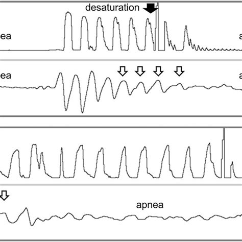 Waveform Examples Top Capnography Bottom Nasal Pressure Monitoring