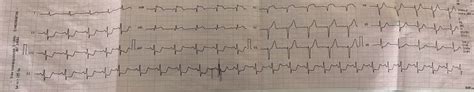 Pavel Somov On Linkedin Stemi Pci Stent Ecg