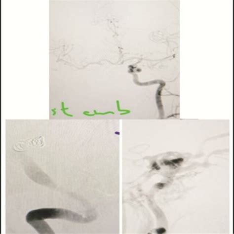 Trans Arterial Coil Embolization Download Scientific Diagram