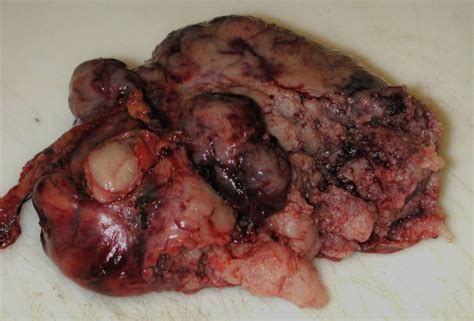 Macroscopic Appearance Of Duodenal Gist Specimen Download Scientific
