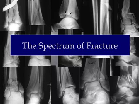 Lecture Ucmc Pilon Plafond Fracture Distal Tibia Ppt Death Injury