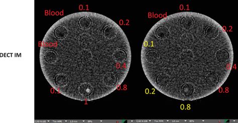 Dual‐energy Computed Tomography Dect Iodine Map Im Images