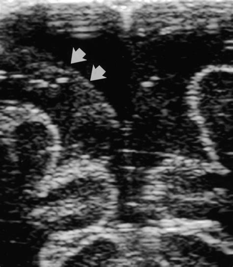 High Frequency Linear Array Transducer At Kenneth Keene Blog