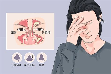 清鼻堂鼻窦炎和感冒你能区分吗鼻塞脓涕嗅觉减退通通找上门 清鼻堂官网 清鼻堂品牌鼻炎店 鼻炎 鼻窦炎 乔竺清鼻堂