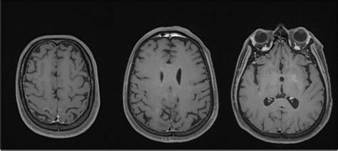 T1 Contrast Axial Image Of Mri Brain Shows Linear Enhancement Along The Download Scientific