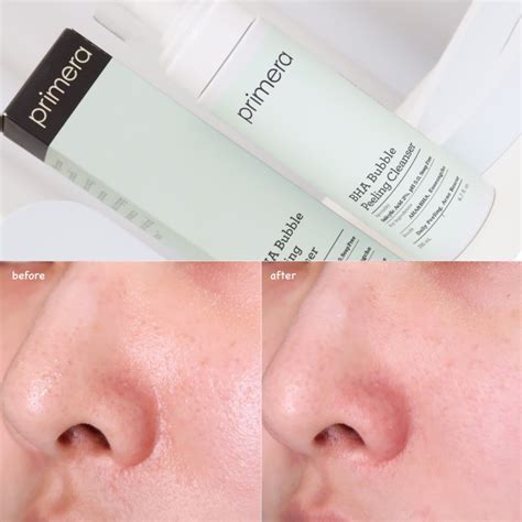 프리메라 바하 버블 필링 클렌저 여드름 피부에 잘 맞아요 네이버 블로그