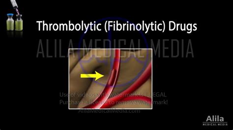 Alila Medical Media Ventricular Fibrillation V Fib Medical Animation
