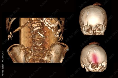 Foto Computed Tomography Of The Spine With A Fracture Of The Vertebrae