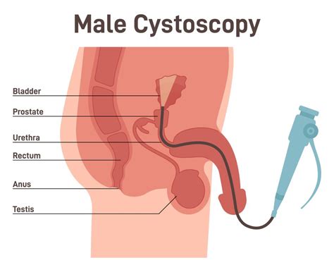 Private Flexible Cystoscopy London Northway Clinic