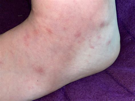 Красные пятна с вкраплениями Вопрос дерматологу 03 Онлайн