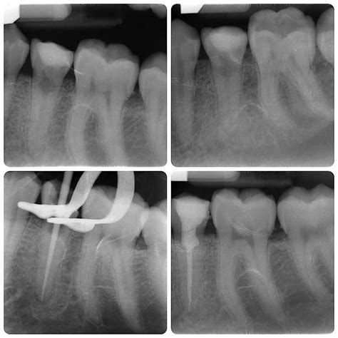 Internal Resorption Belfast Endodontics