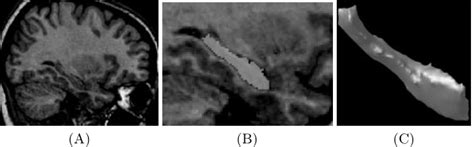 pdf hippocampal shape analysis using medial surfaces 2005