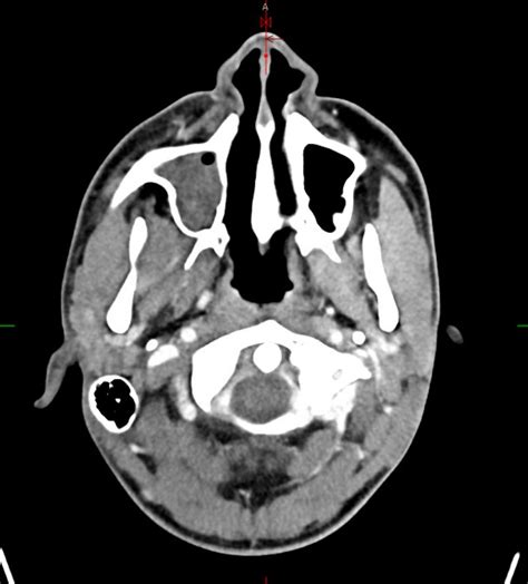 Post Influenza Fusobacterium Infection A Rare Cause Of Jaundice Shm