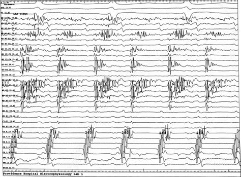 Intracardiac Tracing Illustrating ~70 Of The Tachycardia Cycle Length Download Scientific