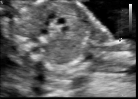 Hypoplastic Right Heart Iame