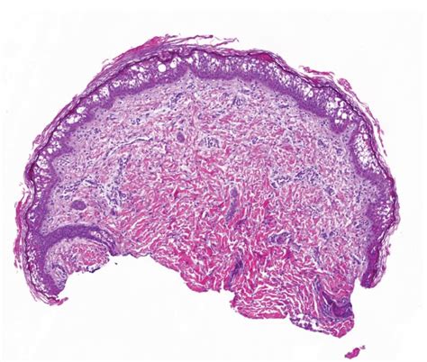 Jama Dermatology On Linkedin Newborn Girl Presenting With Erythema And Blisters