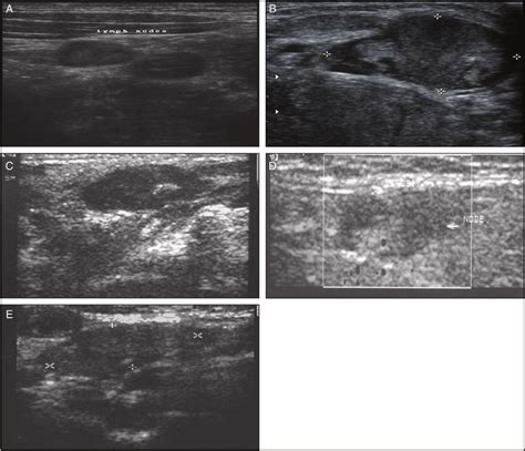 Ultrasonograph Showing Homogenous Hypoechoic Pattern A Heterogeneous