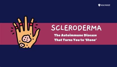 Scleroderma The Autoimmune Disease That Turns You To ‘stone Healthooze