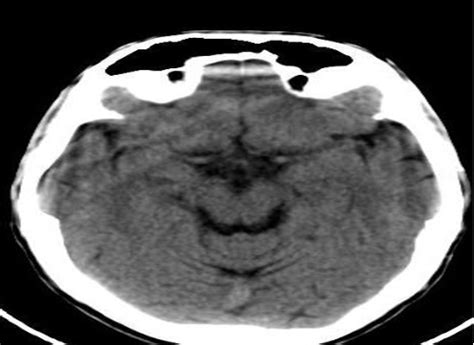 Figure 2 From Brain Ct Scan Images Classification Using Pca Wavelet Transform And K Nn