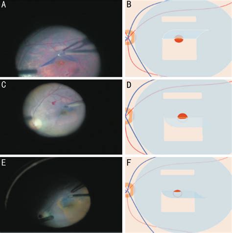 Classifications Of Ilm Retina Adhesive Forces A B Grade Mild Only Download Scientific