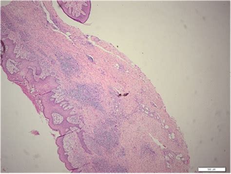 A Rare Case Study Of Pyoderma Gangrenosum With Dilated Cardiomyopathy And Multiple Cerebral A Rare Case Study Of Pyoderma Gangrenosum With Dilated Cardiomyopathy And Multiple Cerebral
