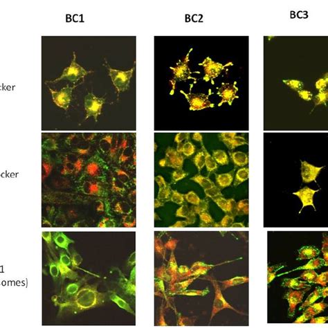 Drug Induced Skin Pigmentation A Minocyline Pigmentation B